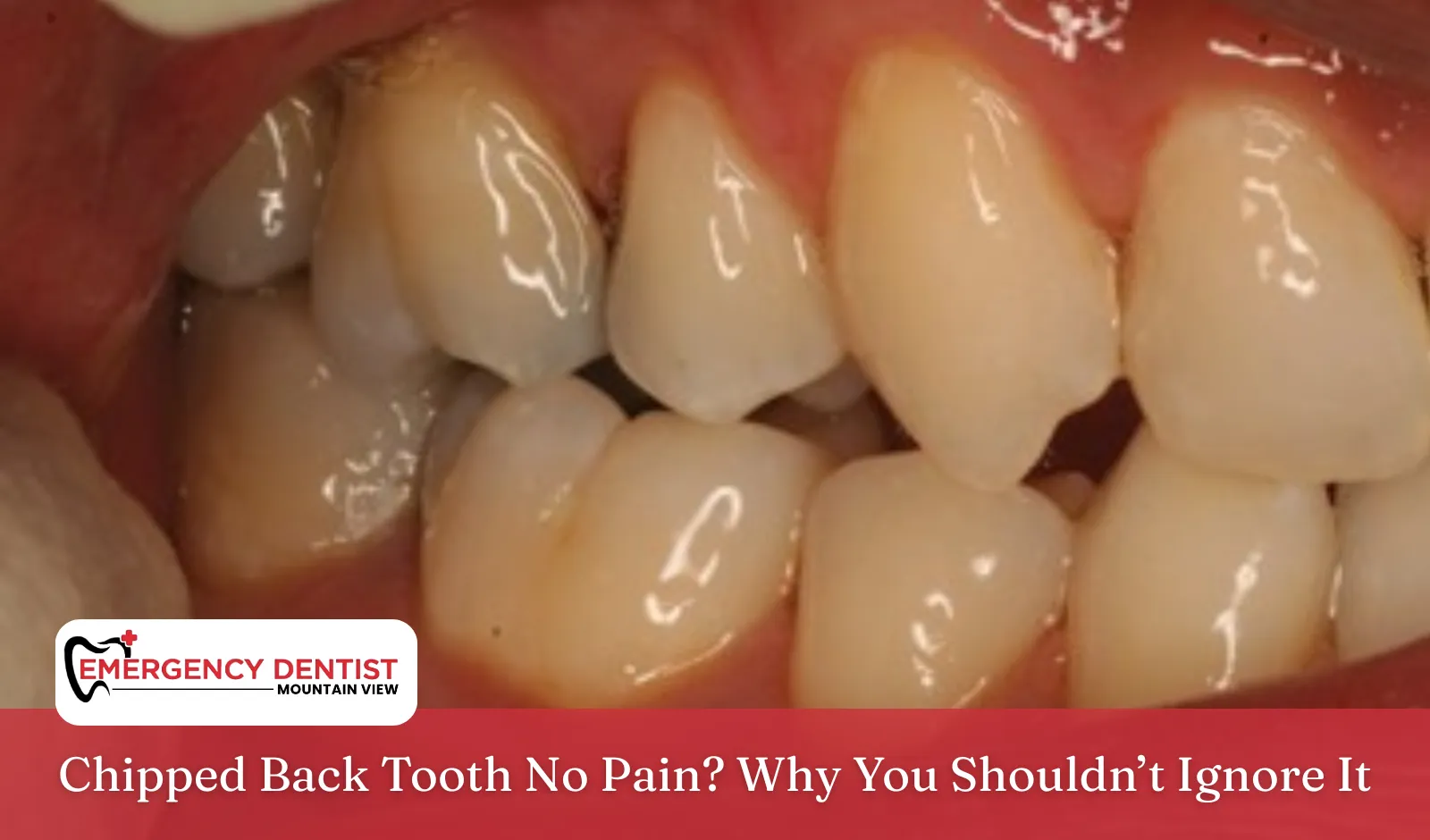 Chipped Back Tooth No Pain? Why You Shouldn’t Ignore It